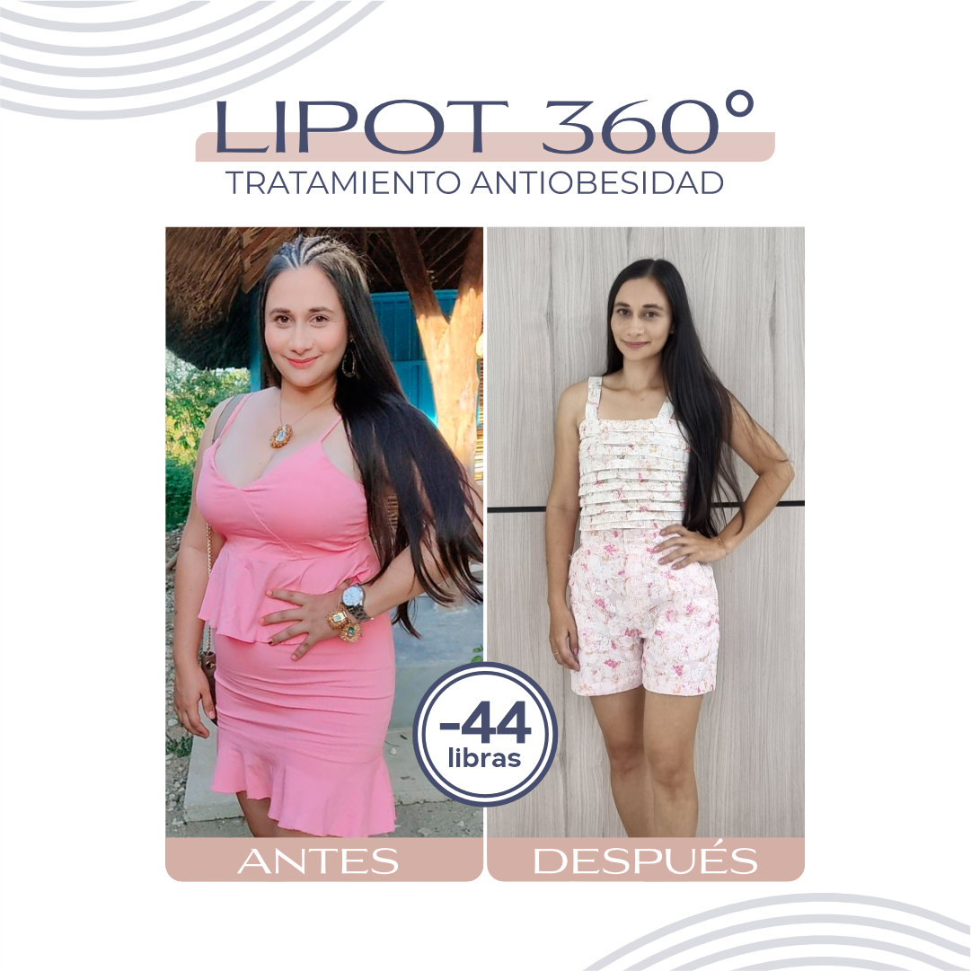 Tratamiento Lipo T 360 | Tu Centro Estético de confianza en Bogotá ...